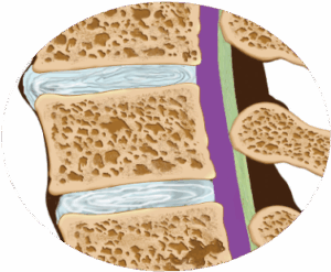Minimally Invasive Lumbar Decompression (MILD) - WashU Medicine Pain Center