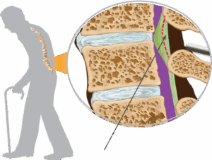 Minimally Invasive Lumbar Decompression (MILD) - WashU Medicine Pain Center
